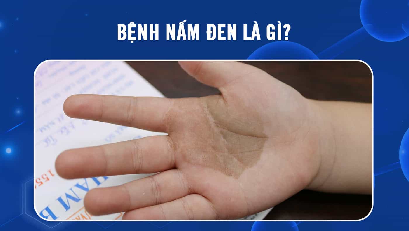 Bệnh nấm đen là gì? - Hệ thống Phòng khám Chuyên khoa Da liễu Maia&Maia