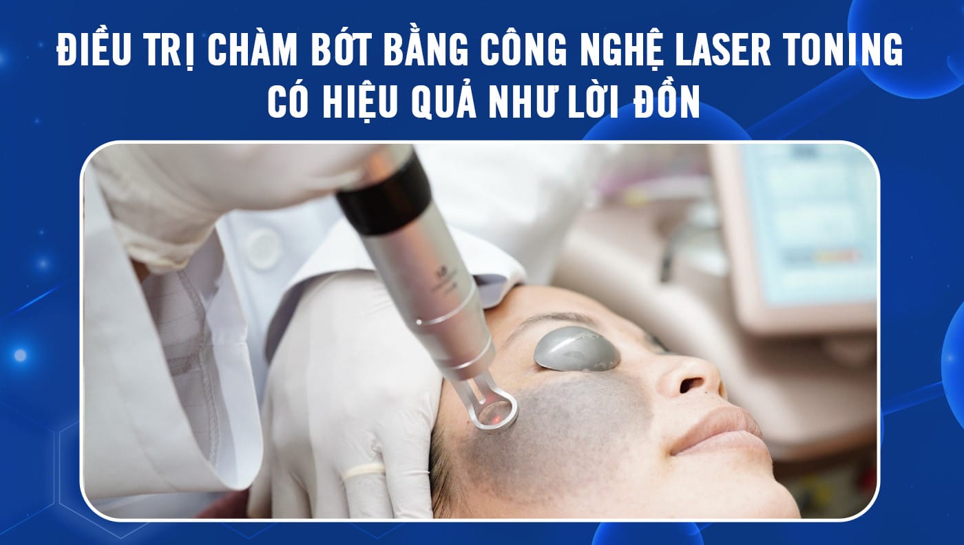 Điều trị chàm bớt bằng công nghệ Laser Toning có thực sự hiệu quả