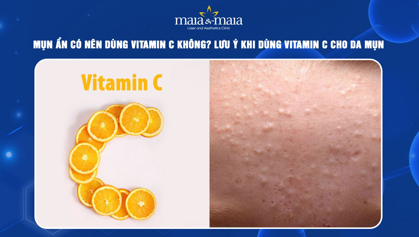 Mụn ẩn có nên dùng vitamin C không? Lưu ý khi dùng vitamin C