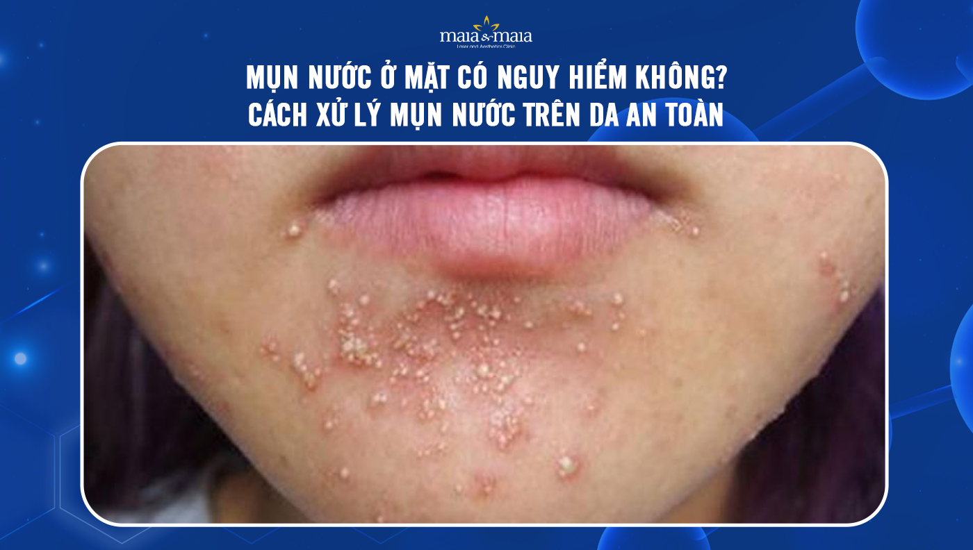 Mụn nước ở mặt có nguy hiểm không? Cách xử lý hiệu quả