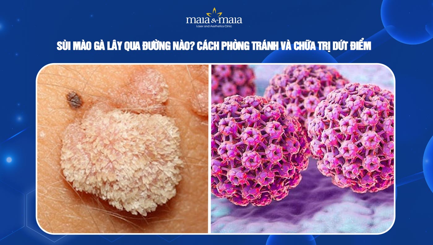 Sùi mào gà lây qua đường nào? 4 con đường lây lan phổ biến