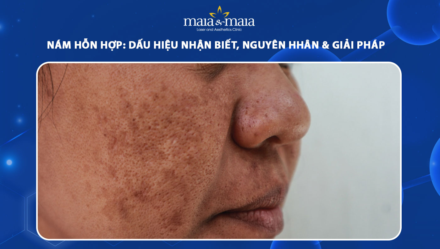 Nám hỗn hợp: Dấu hiệu nhận biết, nguyên hhân & giải pháp