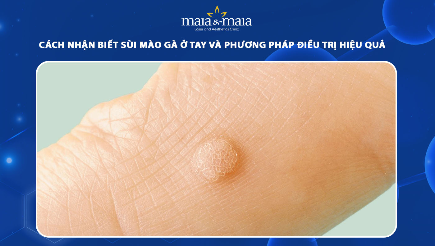 Nhận biết sùi mào gà ở tay và phương pháp điều trị hiệu quả