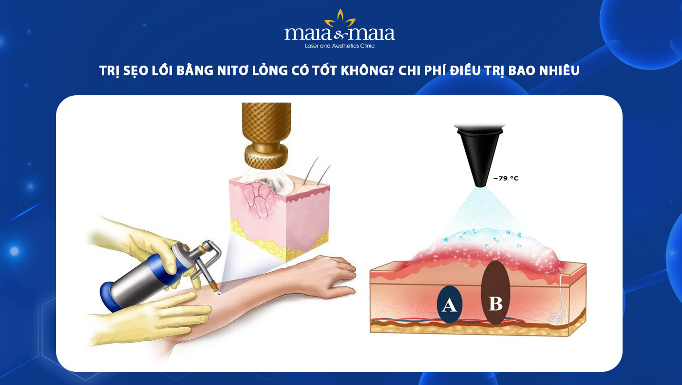 Trị sẹo lồi bằng nitơ lỏng có tốt không? Lưu ý cần biết