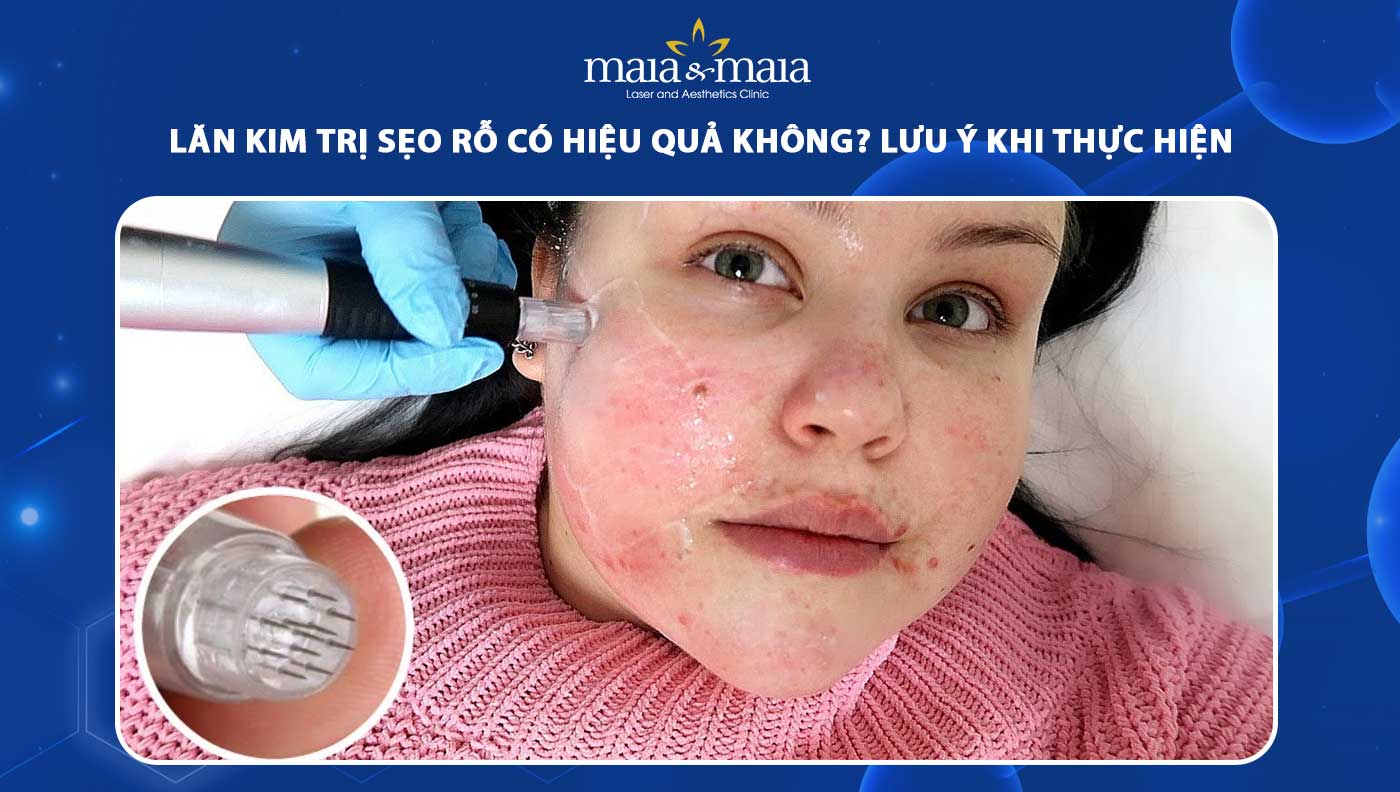 Lăn kim trị sẹo rỗ có hiệu quả không? Lưu ý khi thực hiện