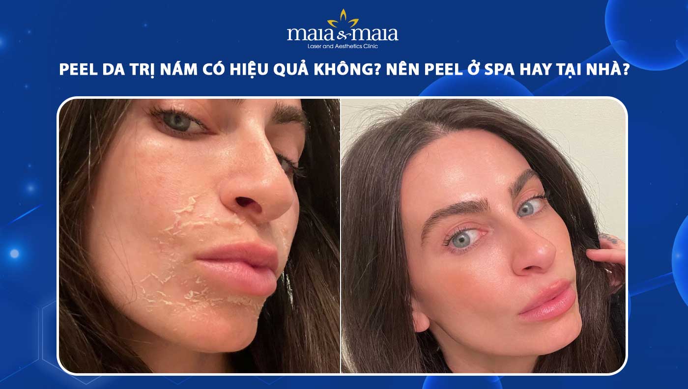 Peel da trị nám có tốt không? Nên peel ở spa hay tại nhà?