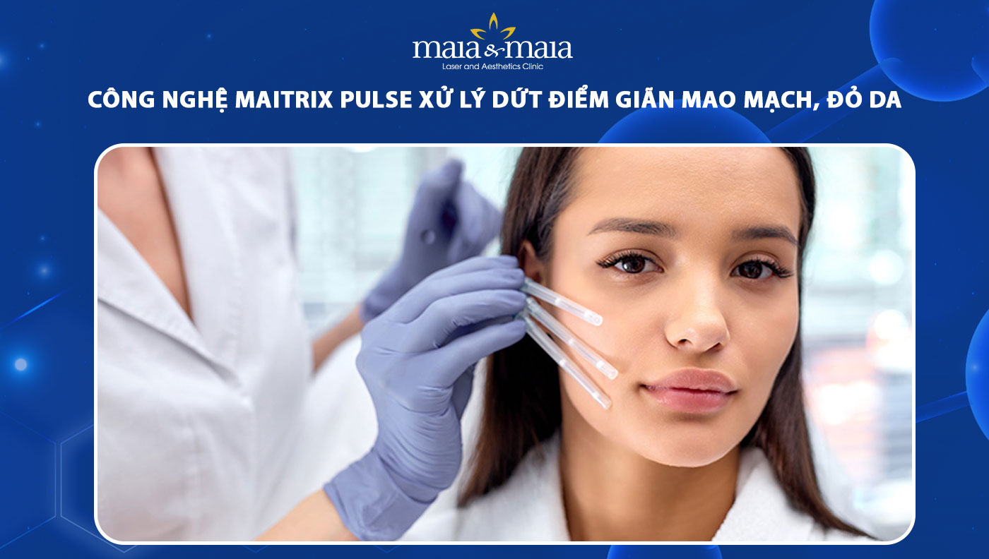 Công nghệ Maitrix Collagen 8D căng chỉ không phẫu thuật