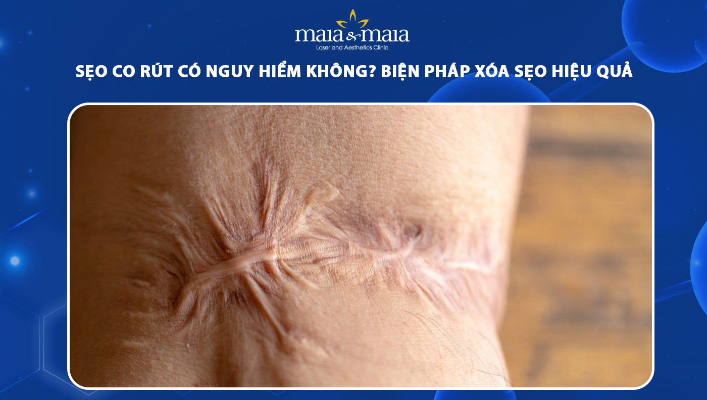 Sẹo co rút có nguy hiểm không? Biện pháp xóa sẹo hiệu quả