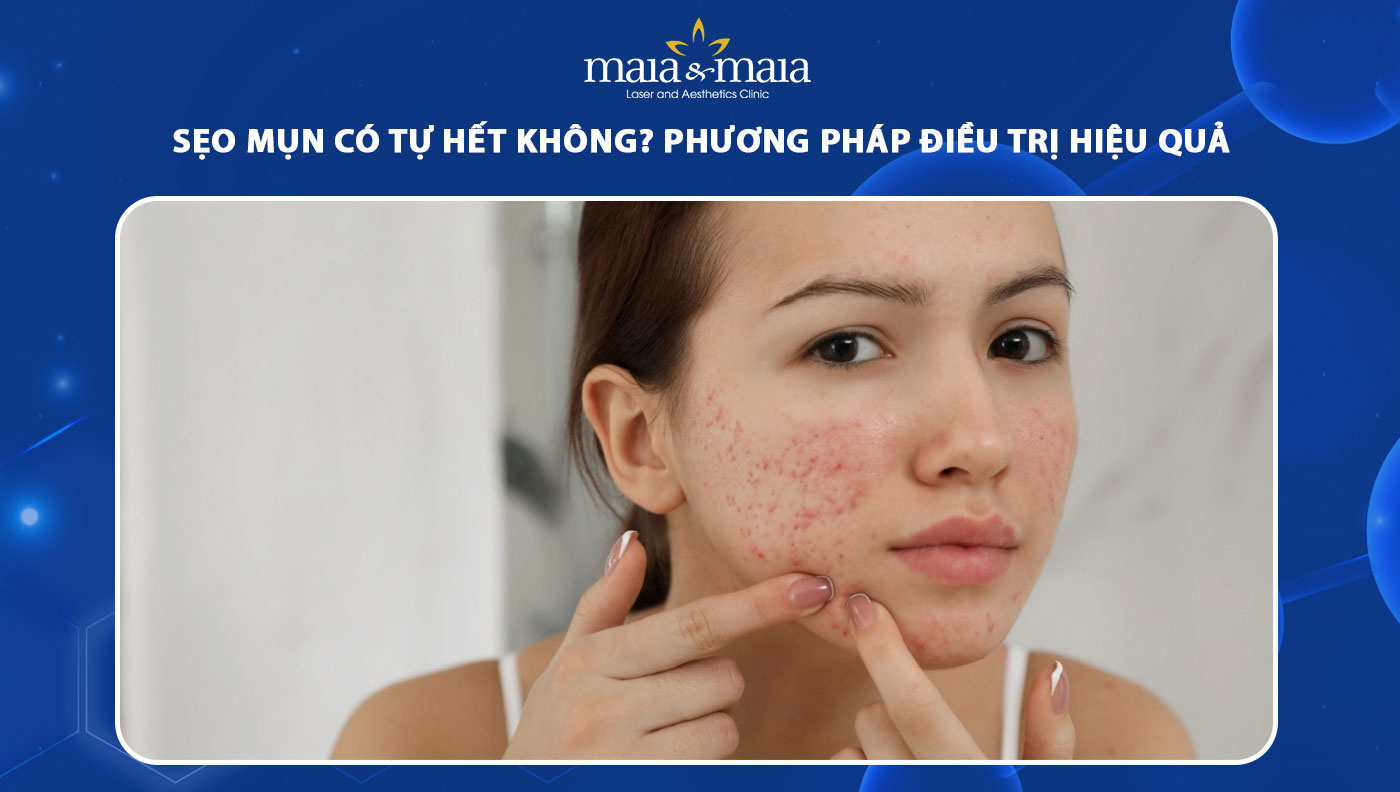 Bị sẹo mụn có tự hết không? Phương pháp điều trị hiệu quả