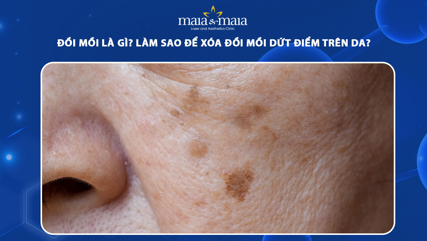 Đồi mồi: Nguyên nhân hình thành và cách điều trị dứt điểm