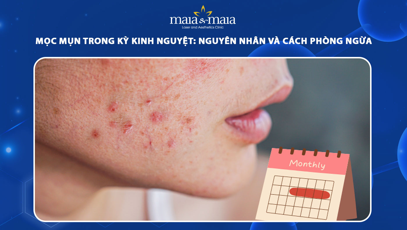 Bí quyết ngăn ngừa mọc mụn trong kỳ kinh nguyệt