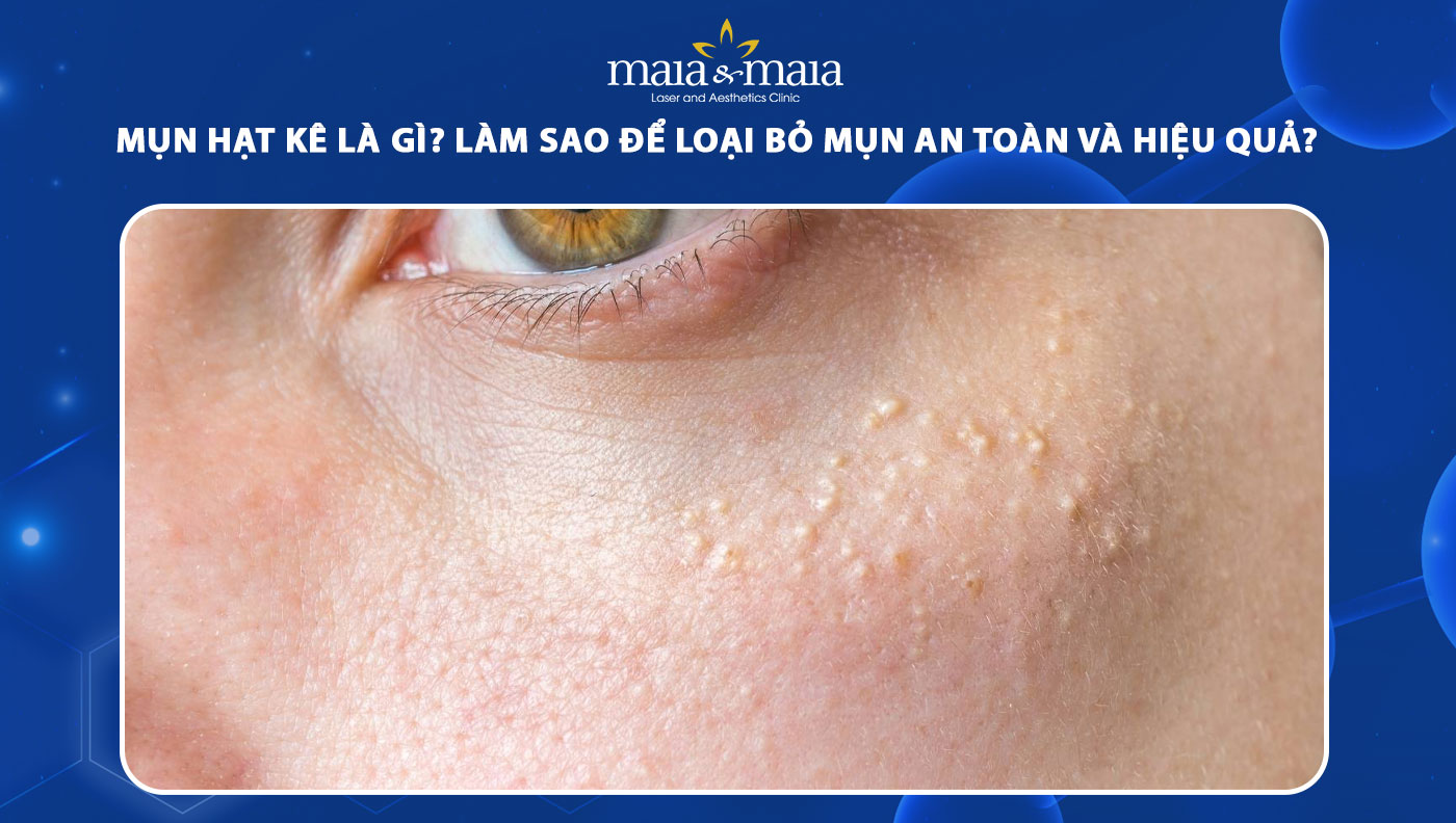 Mụn hạt kê là gì? Giải pháp xử lý mụn an toàn và hiệu quả