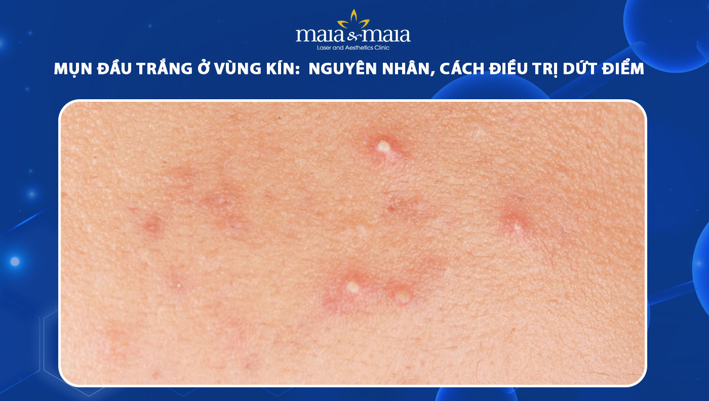 Mụn đầu trắng ở vùng kín: Nguyên nhân và cách điều trị