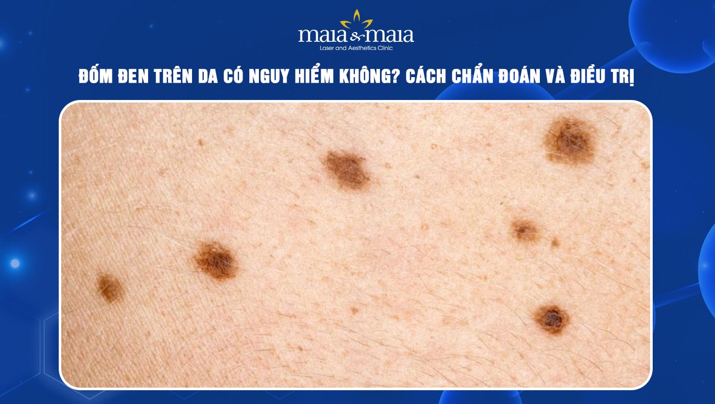 Đốm đen trên da có nguy hiểm không? Chẩn đoán và điều trị