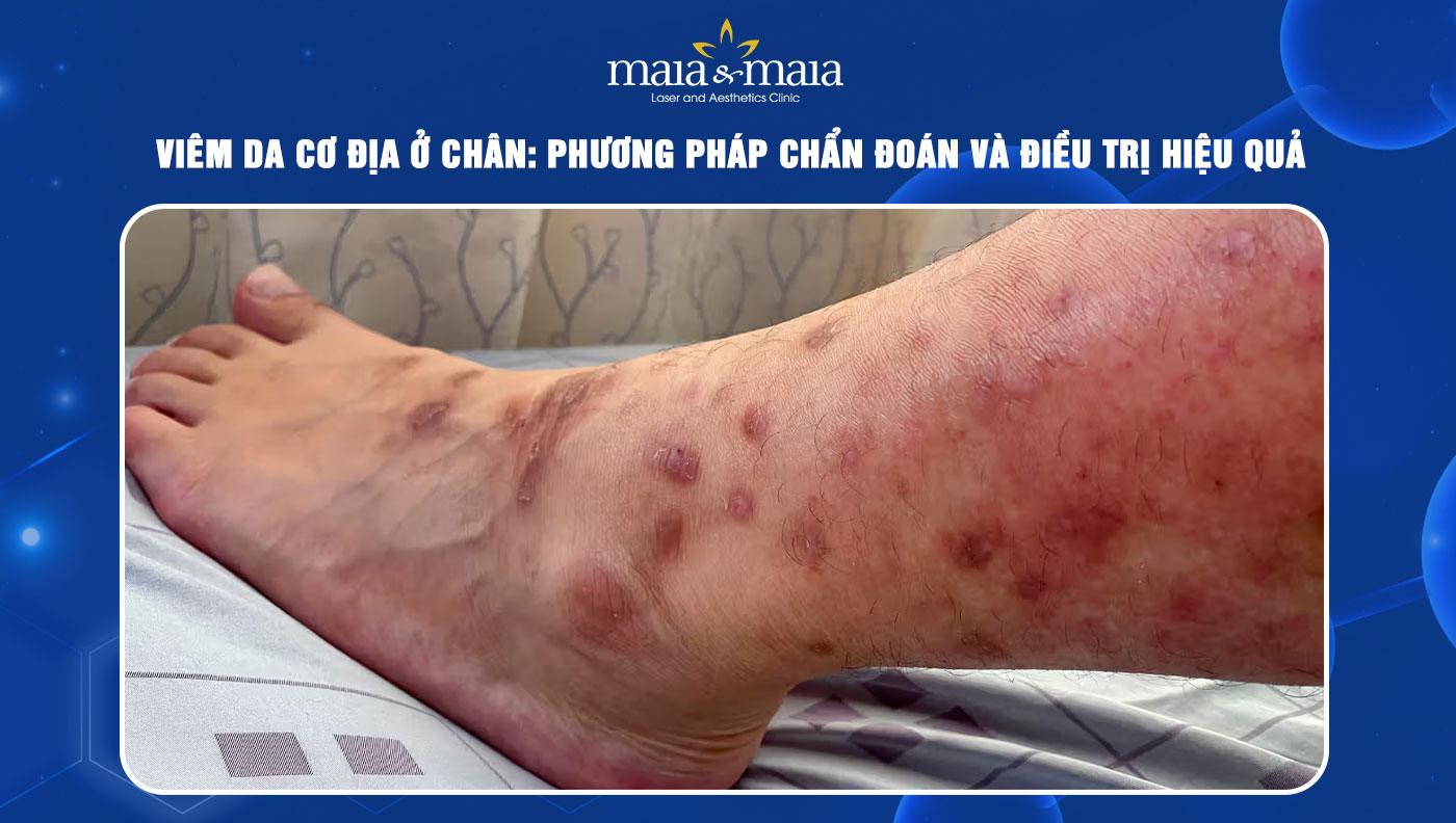 Viêm da cơ địa ở chân: Chẩn đoán và cách điều trị hiệu quả