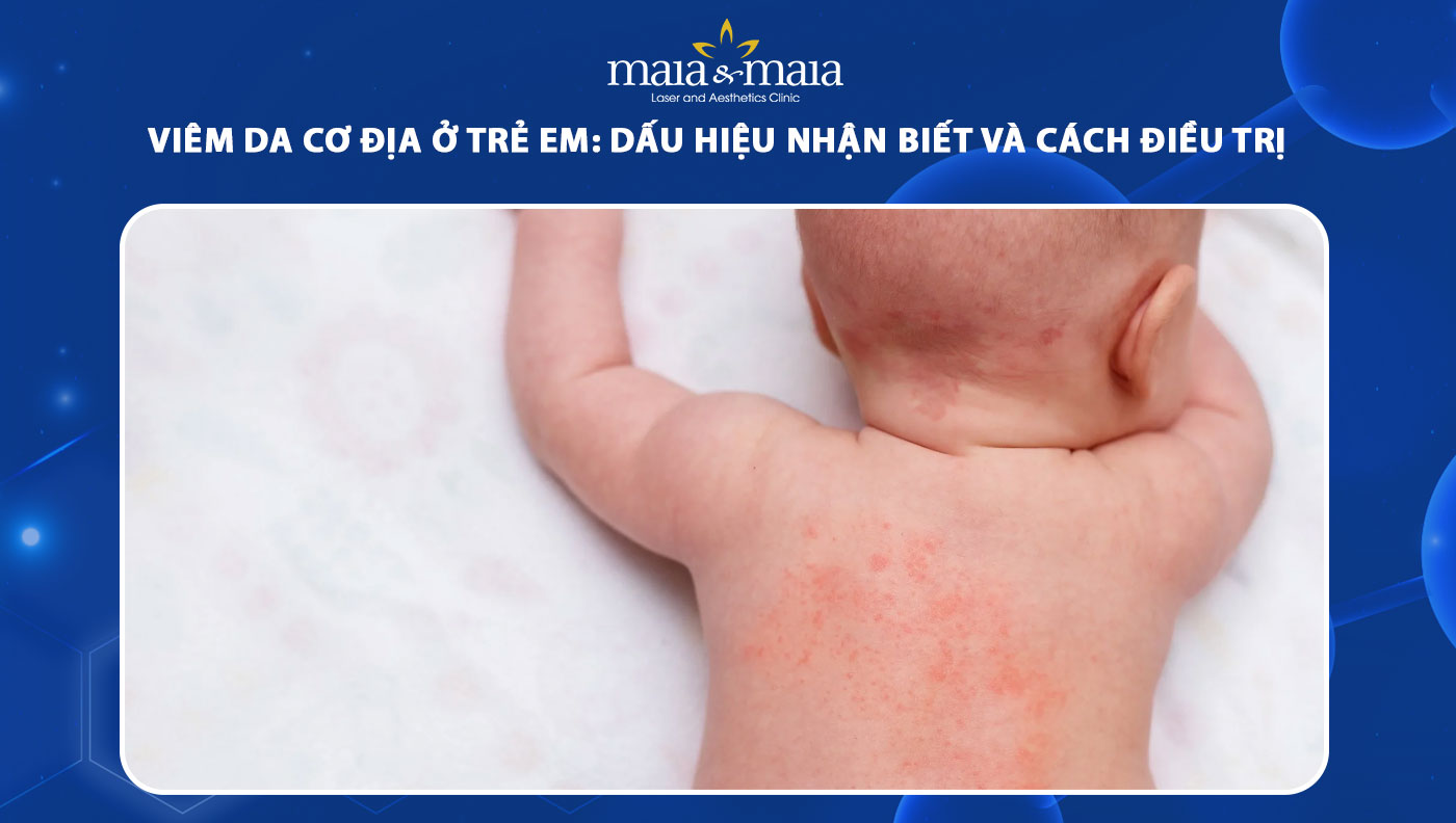 Viêm da cơ địa ở trẻ em: Dấu hiệu nhận biết và cách điều trị