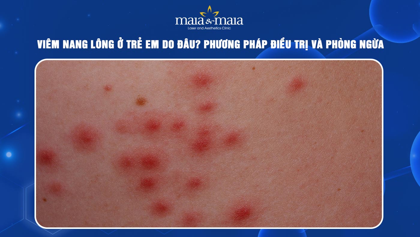 Viêm nang lông ở trẻ em do đâu? Cách điều trị và phòng ngừa