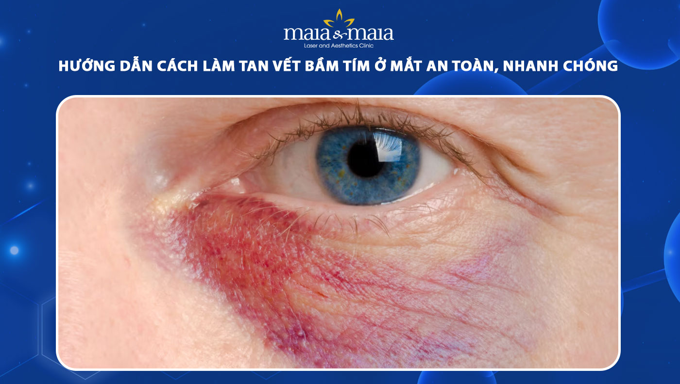 Hướng dẫn làm tan vết bầm tím ở mắt an toàn, nhanh chóng
